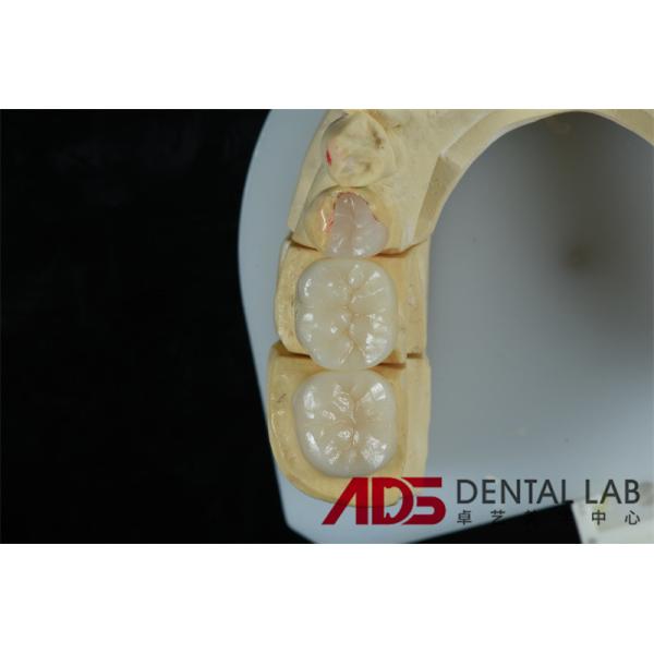 Quality Seamless Porcelain Emax Veneers Teeth Replacement Authentic Looking for sale