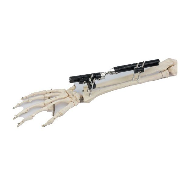 Quality Sterilized Bone Fracture Distal Radius External Fixator for sale