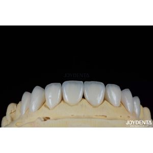 Quality Long-lasting And Stain Resistant Dental Veneers With Personalized Shades For for sale