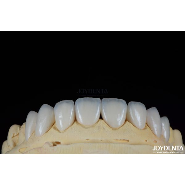 Quality Long-lasting And Stain Resistant Dental Veneers With Personalized Shades For Natural Teeth for sale