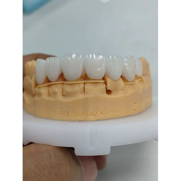 Quality 5mm-6mm Layered Zirconia Crowns Strength Zirconia Multilayer Crown for sale