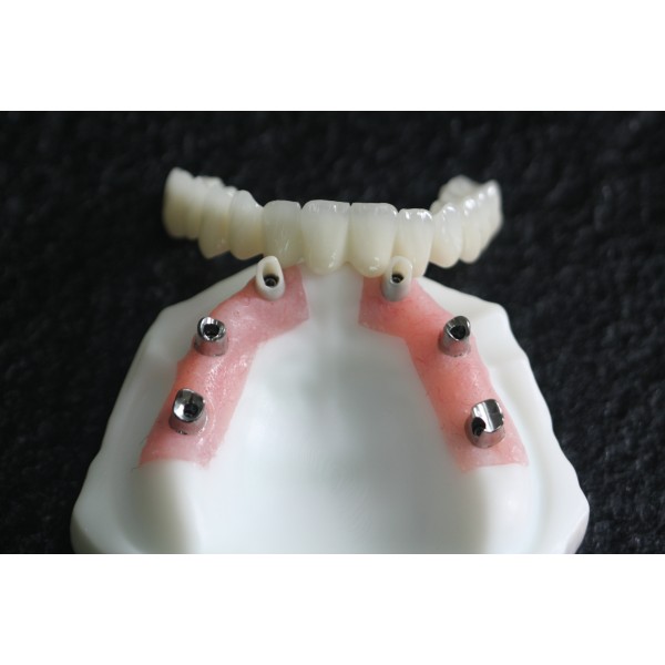 Quality Aesthetic and Biocompatible Zirconia Crown and Abutment for Strong Dental Restoration for sale
