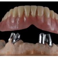 Quality Comfortable Easy Maintenance Telescopic Crowns Customized For Dental Restoration for sale