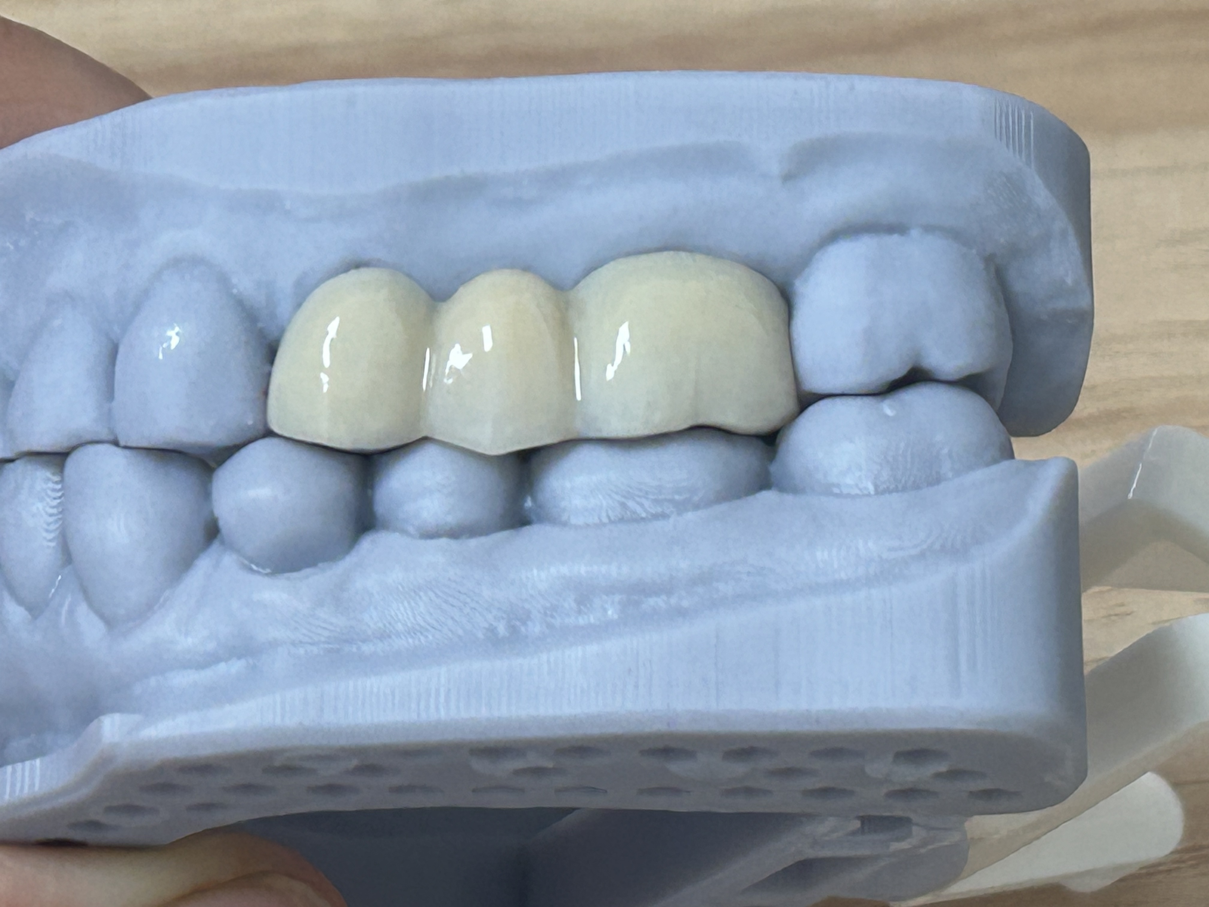 Quality Composite Veneers & Dental Veneers with Customized Shade, Natural Tooth-Like Appearance for Conservative Restoration for sale
