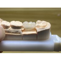 Quality Stain Resistance PFM Ceramic Crown Adjustable With Natural Tooth Shape for sale