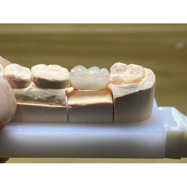 Quality Stain Resistance PFM Ceramic Crown Adjustable With Natural Tooth Shape for sale