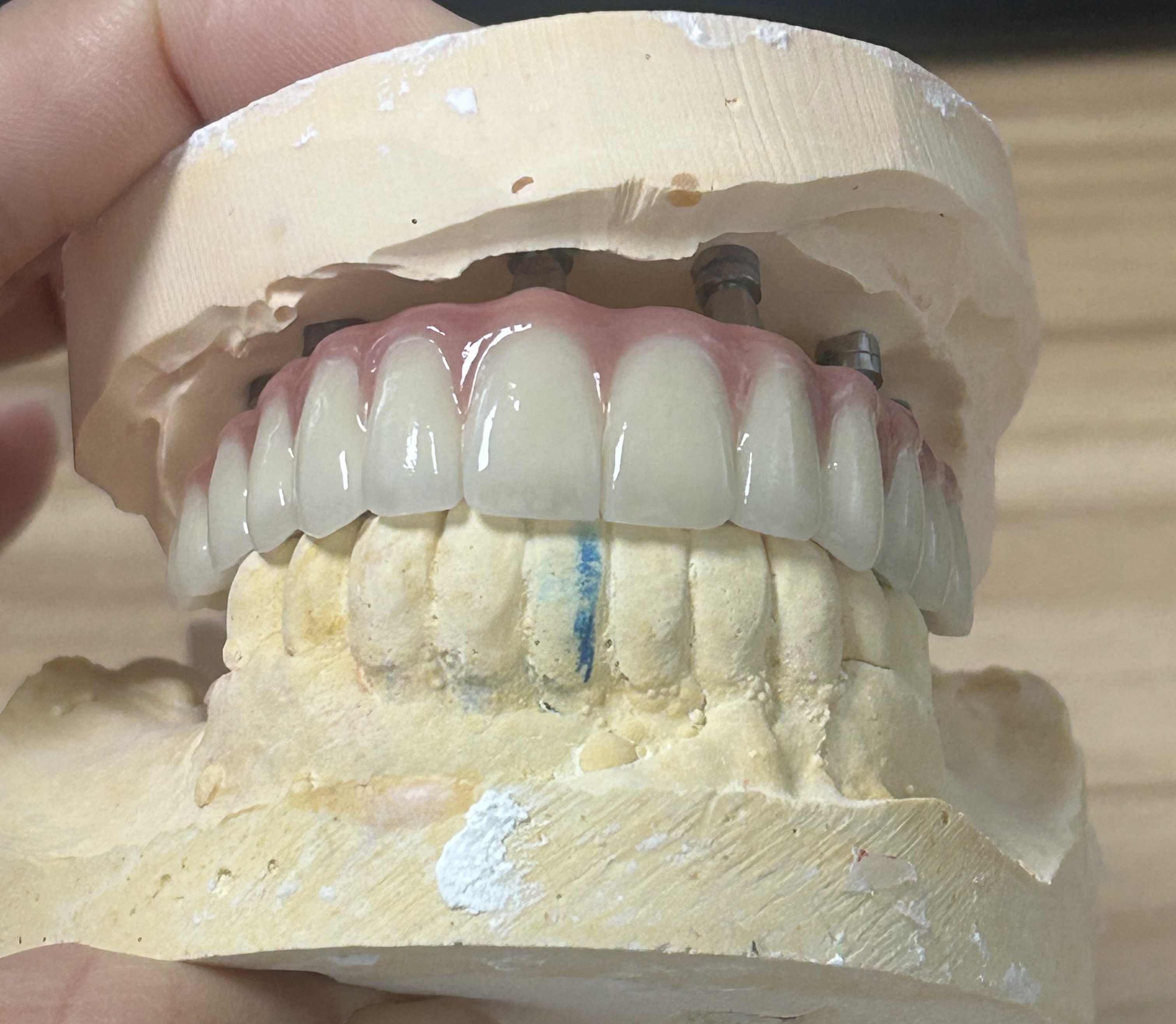Quality High-Strength Dental Zirconia Implant Crown with Natural Translucency & Tooth-Like Appearance via Digital CAD/CAM for sale