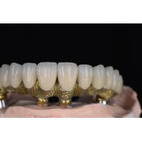 Quality Natural Looking Crown Porcelain Fused To Metal High Precision For Dental for sale