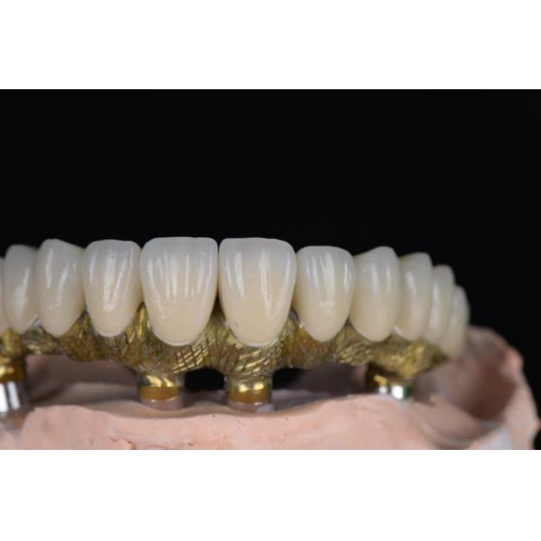 Quality Natural Looking Crown Porcelain Fused To Metal High Precision For Dental Implants for sale