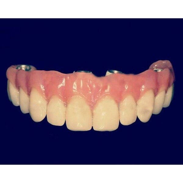 Quality Implant-Supported Bar Attachment in Titanium or Cobalt-Chromium Alloy for Even Force Distribution and Customizable Design for sale