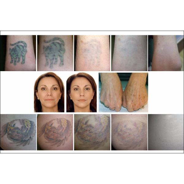 Quality 755nm 1064nm Picosecond Tattoo Removal Machine 500ps Nd Yag Laser for sale
