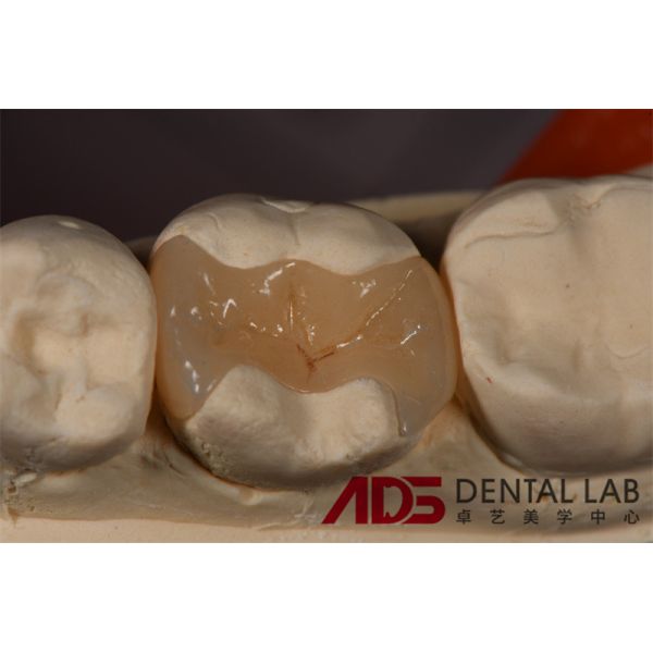 Quality Seamless Porcelain Emax Veneers Teeth Replacement Authentic Looking for sale