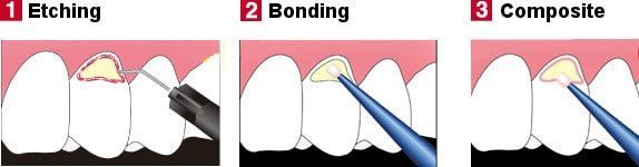 composite bonding