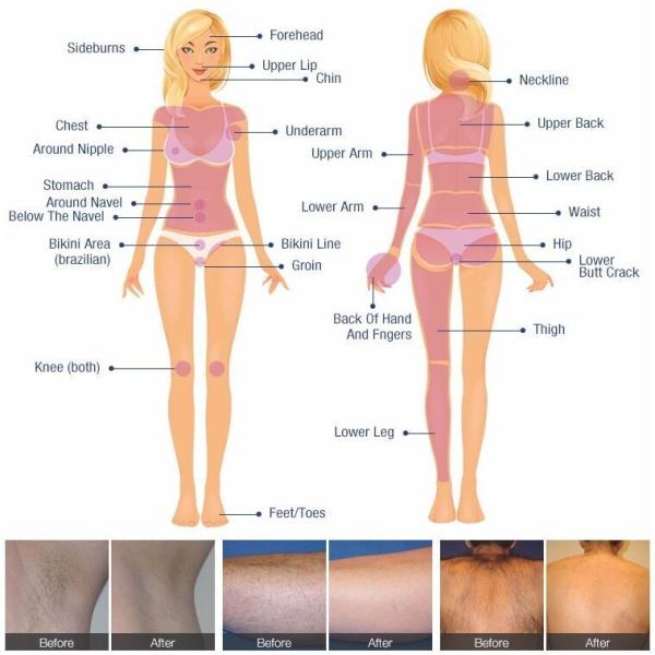 Quality Diode 808 Laser Hair Removal Permanent Machine , Cosmetology Laser Depilation for sale