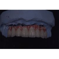 Quality Dental Lab Implant Crowns for sale