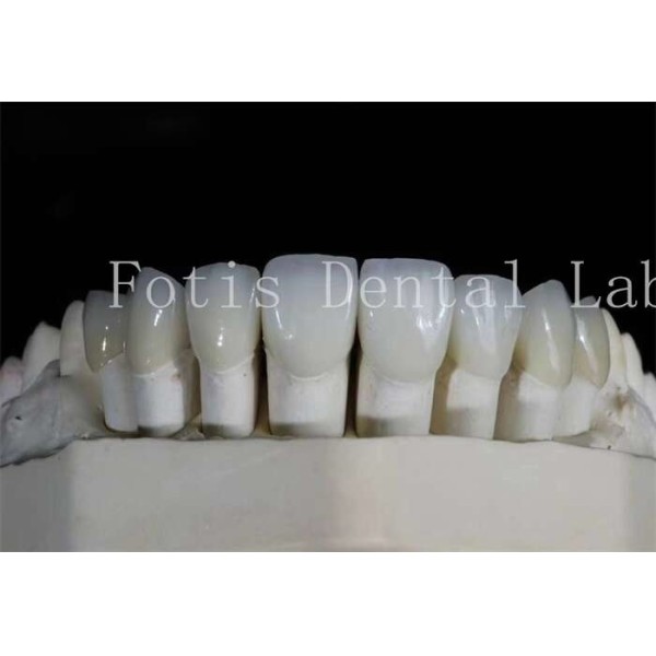 Quality Polished Dental Laminate Veneers High Translucency For Natural Looking Smiles for sale