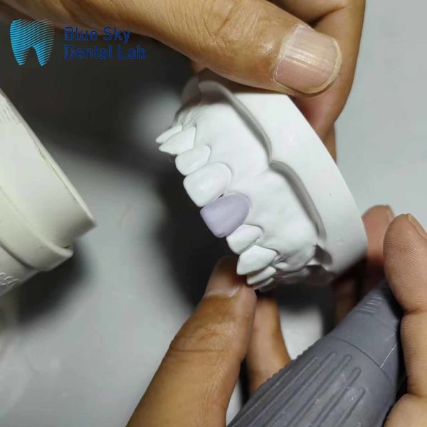 Quality 0.3mm Thin Glass Ceramic Veneer Implants Lightweight Veneer Cases for sale