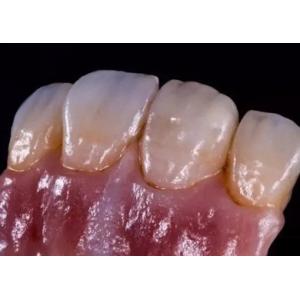 Quality German Amanjilbach Zirconia Dental Crown High Density With Customization for sale