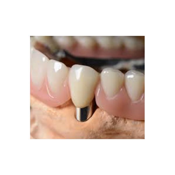 Quality Customizable Dental Telescopic Crown High Precision With Natural Looking for sale