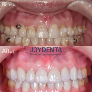 Quality Dental Veneers for Missing Teeth | Global Premium Dental Lab Services for sale
