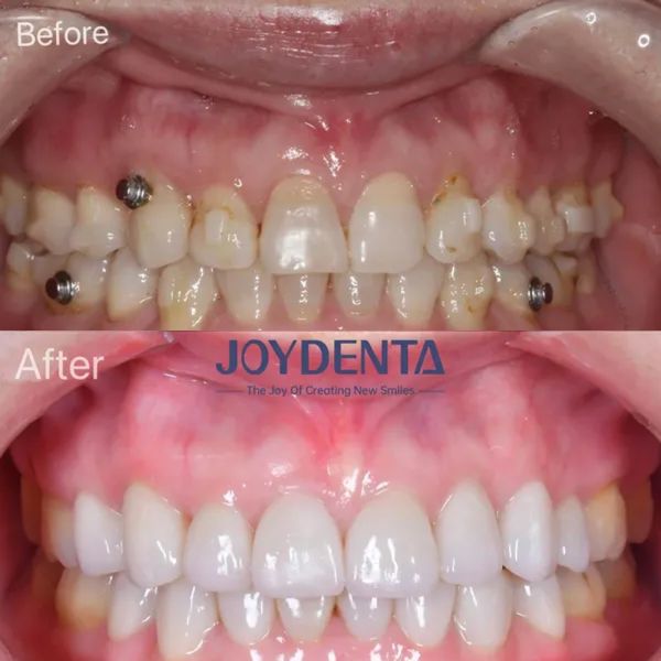 Quality Dental Veneers for Missing Teeth | Global Premium Dental Lab Services for sale