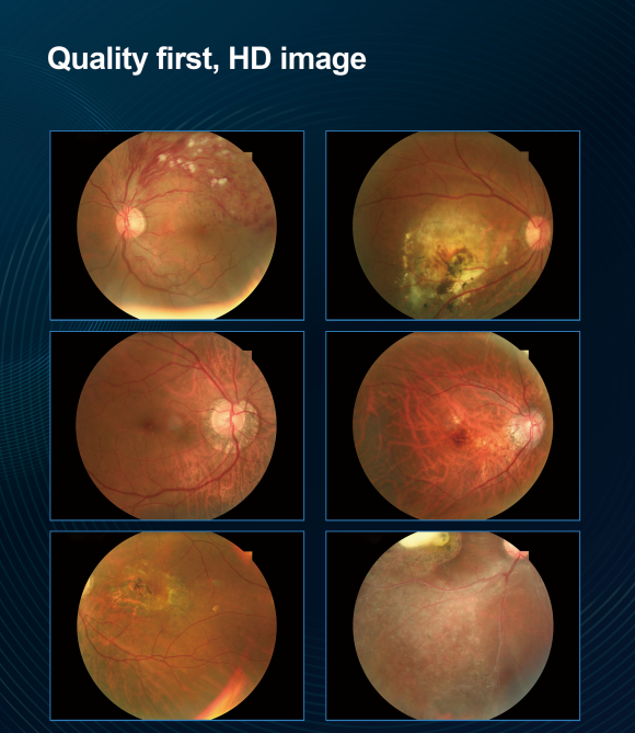 State-of-the-Art Non Mydriatic Fundus Camera with Dual Camera System for Eye Condition Assessment