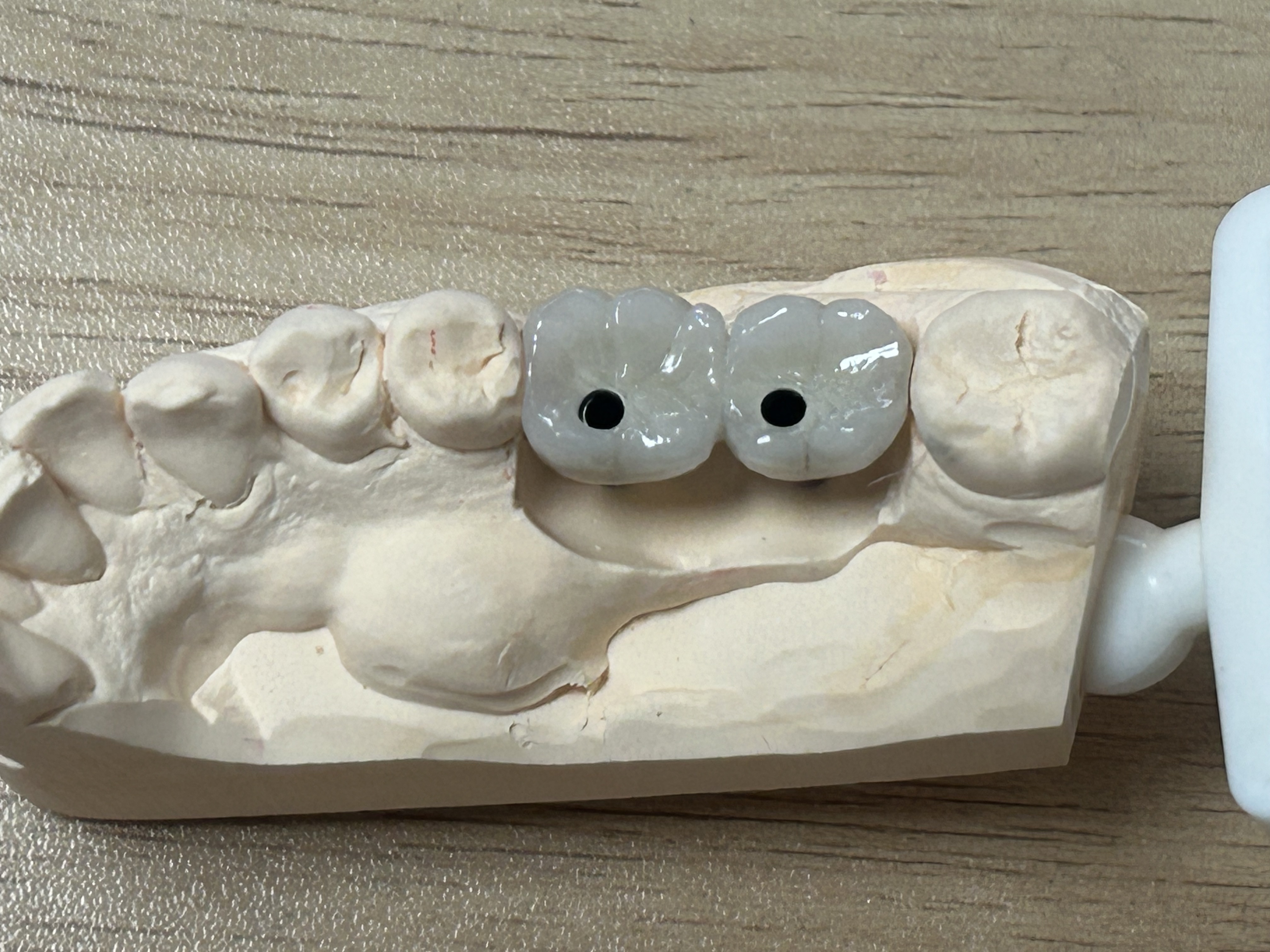Quality Full Zirconia Implant Crown with High Strength and Wear Resistance Natural Tooth-Like Appearance Using Digital CAD/CAM Technology for sale