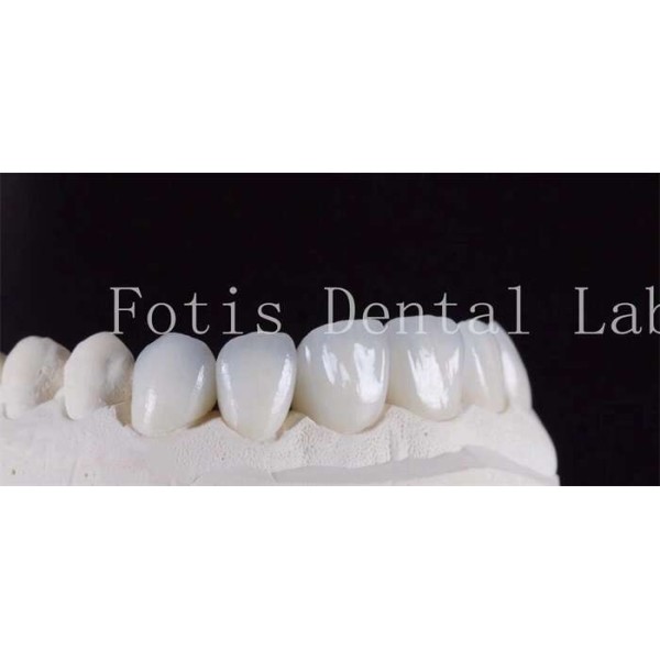 Quality Ultra Strong Translucent Dental Laminate Veneers Natural Color for sale