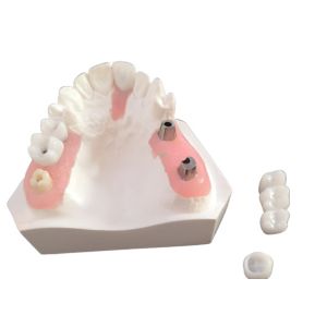 Quality FDA All Zirconia Crown with Implant-Supported Dentures for Dental Lab for sale