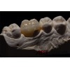 china Precise Ceramic Dental Inlays And Onlays Restoration Stain Resistance