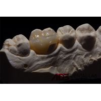 Quality Precise Ceramic Dental Inlays And Onlays Restoration Stain Resistance for sale