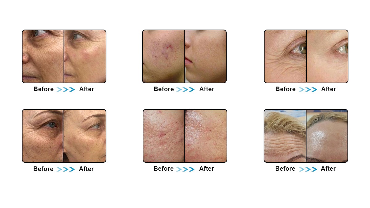 face lift skin tighten machine