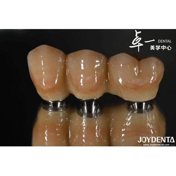 Quality Rough Surface Design Dental Implant for Subcrestal Bone Level Titanium Material for sale