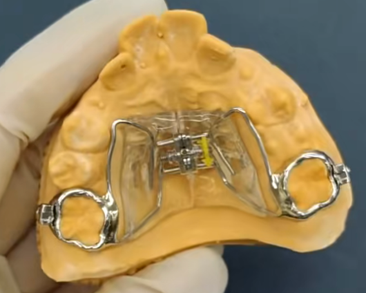 Quality Biocompatible and Clinically Proven Dental Expander - Custom-fitted Maxillary for sale