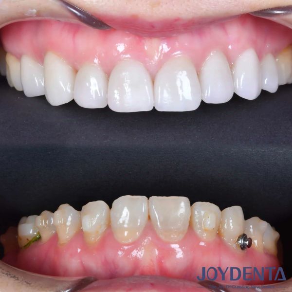 Quality Dental Veneers for Missing Teeth | Global Premium Dental Lab Services for sale