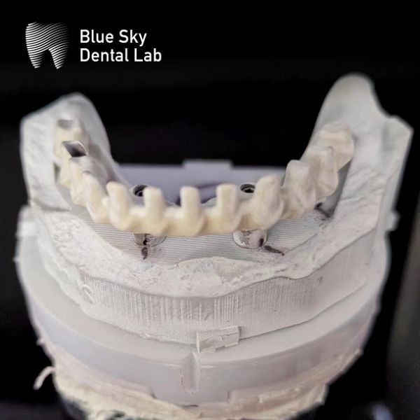 Quality Pure Titanium Frame Malo Bridge Customizable Blue Sky Implant for sale