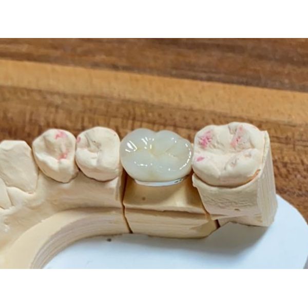 Quality High Aesthetics PFM Crown Cocr Alloy Porcelain Fused To Metal Crown for sale