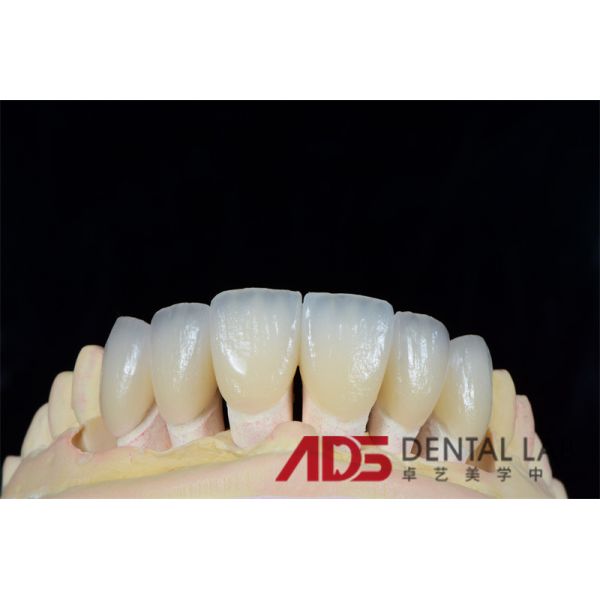 Quality Customized Dental Veneers Offer Perfect Color Match and Comfortable Fit for sale