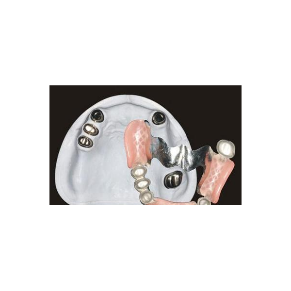 Quality Telescope crowns and denture for sale