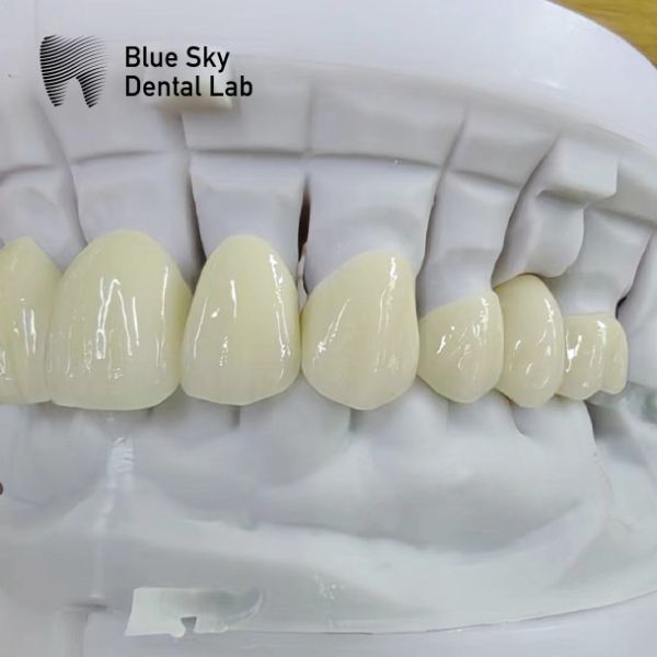 Quality Translucent Layered Zirconia Crown Dental Restoration Multilayer Zirconia Crown for sale