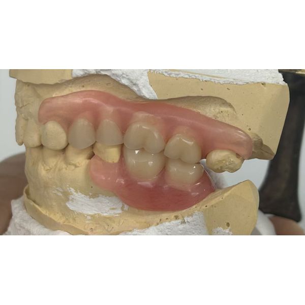 Quality Removable Denture with Lingual Bar Retention for High Precision Fit and for sale