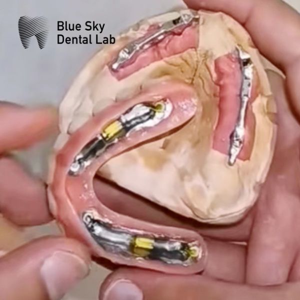 Quality Blue Sky Dental Implants With Titanium Bar For Removable Prosthesis for sale