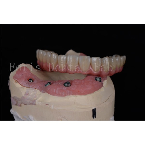 Quality Customizable All On 4 All On 6 Dental Implants For Complete Oral Rehabilitation for sale