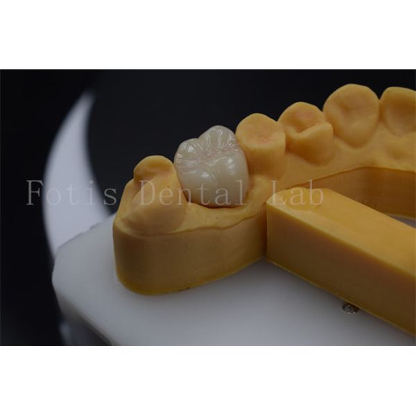 Quality Titanium / PFM Denture Crown Customizable Zirconia Implant Crown Durable for sale