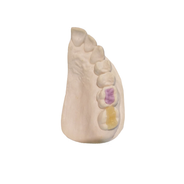 Quality Custom High-Density Custom Dental Ceramics FDA All-Ceramic Crown for sale