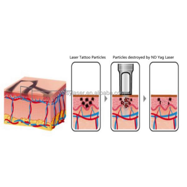 Quality Alexandrite Melasma Picosecond Laser Machine 755nm Tattoo Laser Equipment for sale