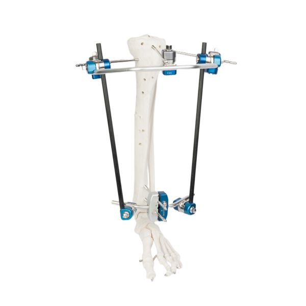 Gather Hoffmann 2 External Fixation Rods For Pelvic Fractures from ...