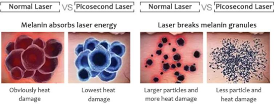 Uniform Spot 1064nm Pigmentation Removal and professional  tattoo removal Picosecond Laser Equipment 1