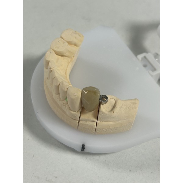 Quality ERA Precision Dental Attachment for High-Accuracy Dental Applications for sale