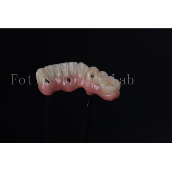 Quality Individual All On 4 All On 6 Endosteal Implants For Immediate Tooth Replacement for sale
